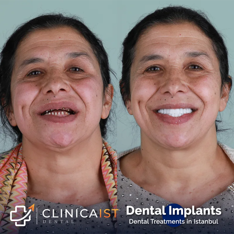 Dental Implants in Turkey | Premium Treatment in Istanbul