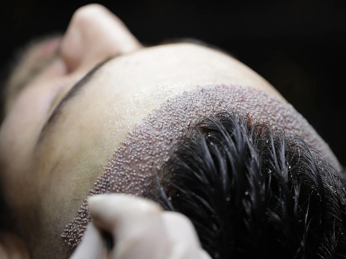 No Shave Hair Transplant Istanbul | Unshaven FUE Hair Transplant Turkey